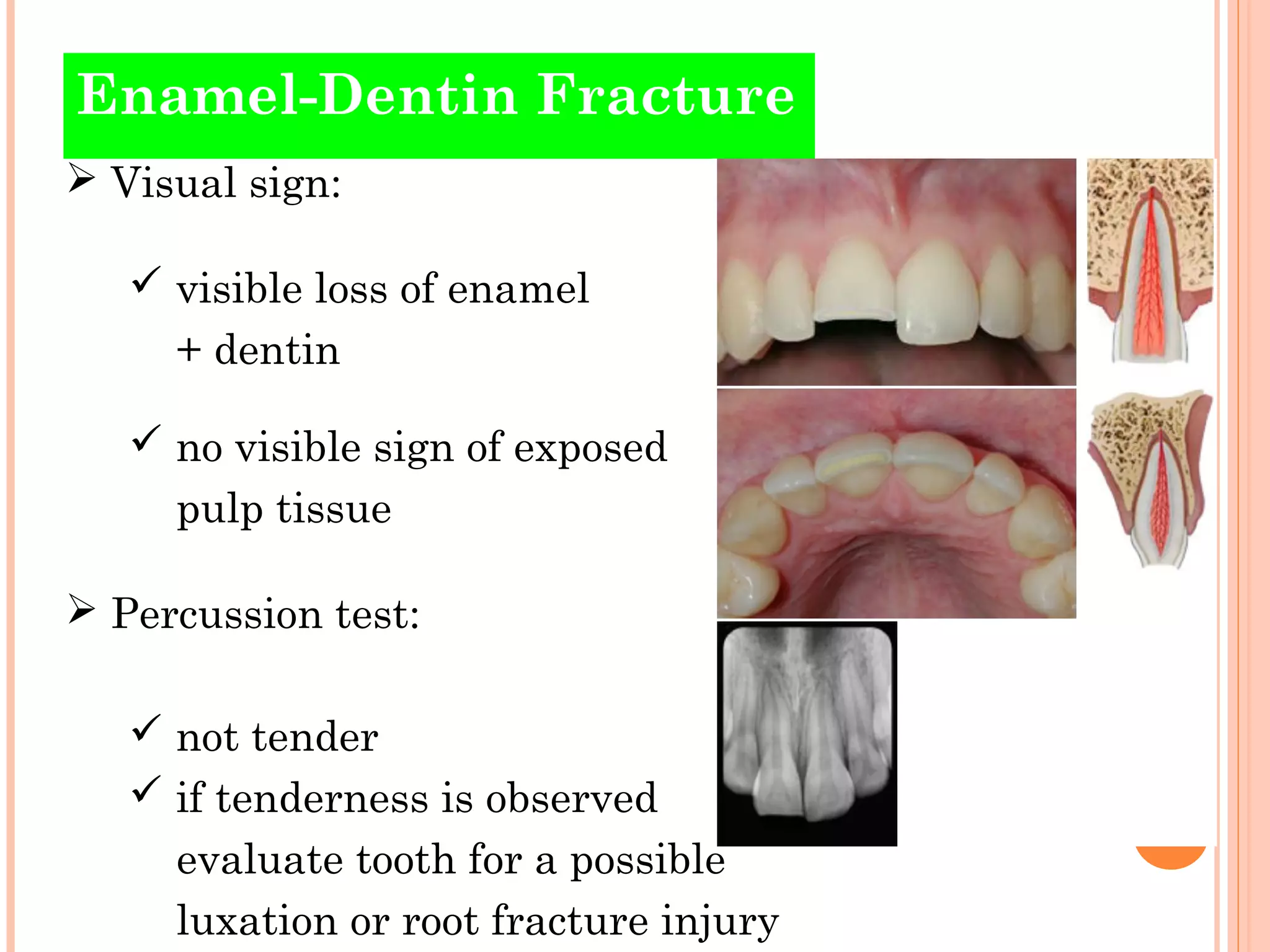 Traumatic injuries of teeth | PPT