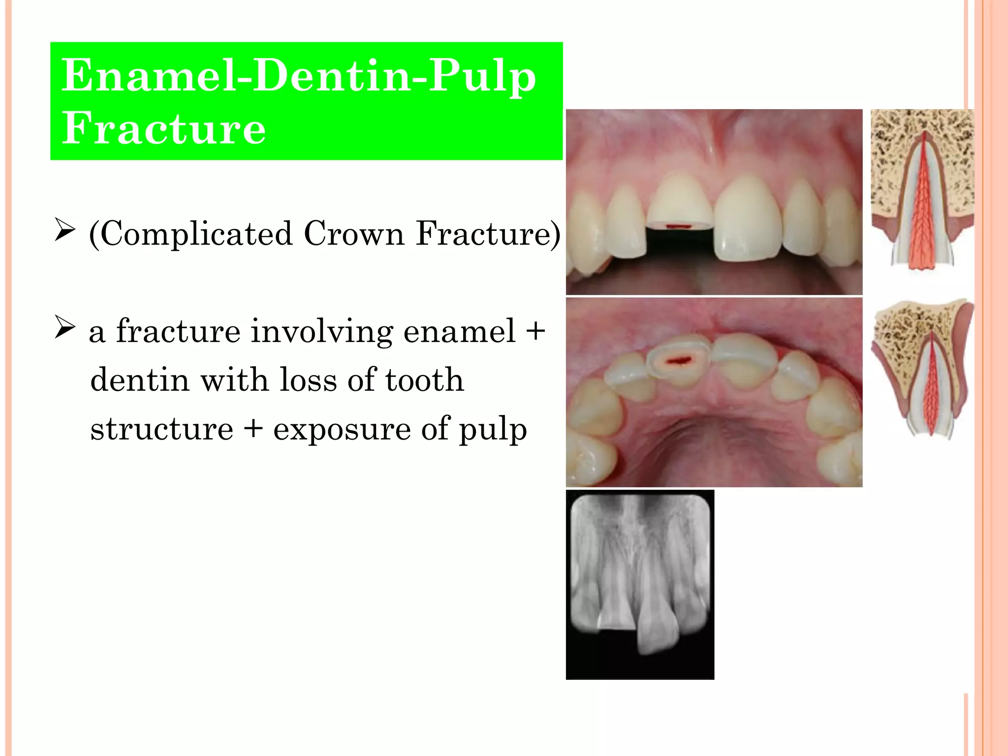 Traumatic injuries of teeth | PPT