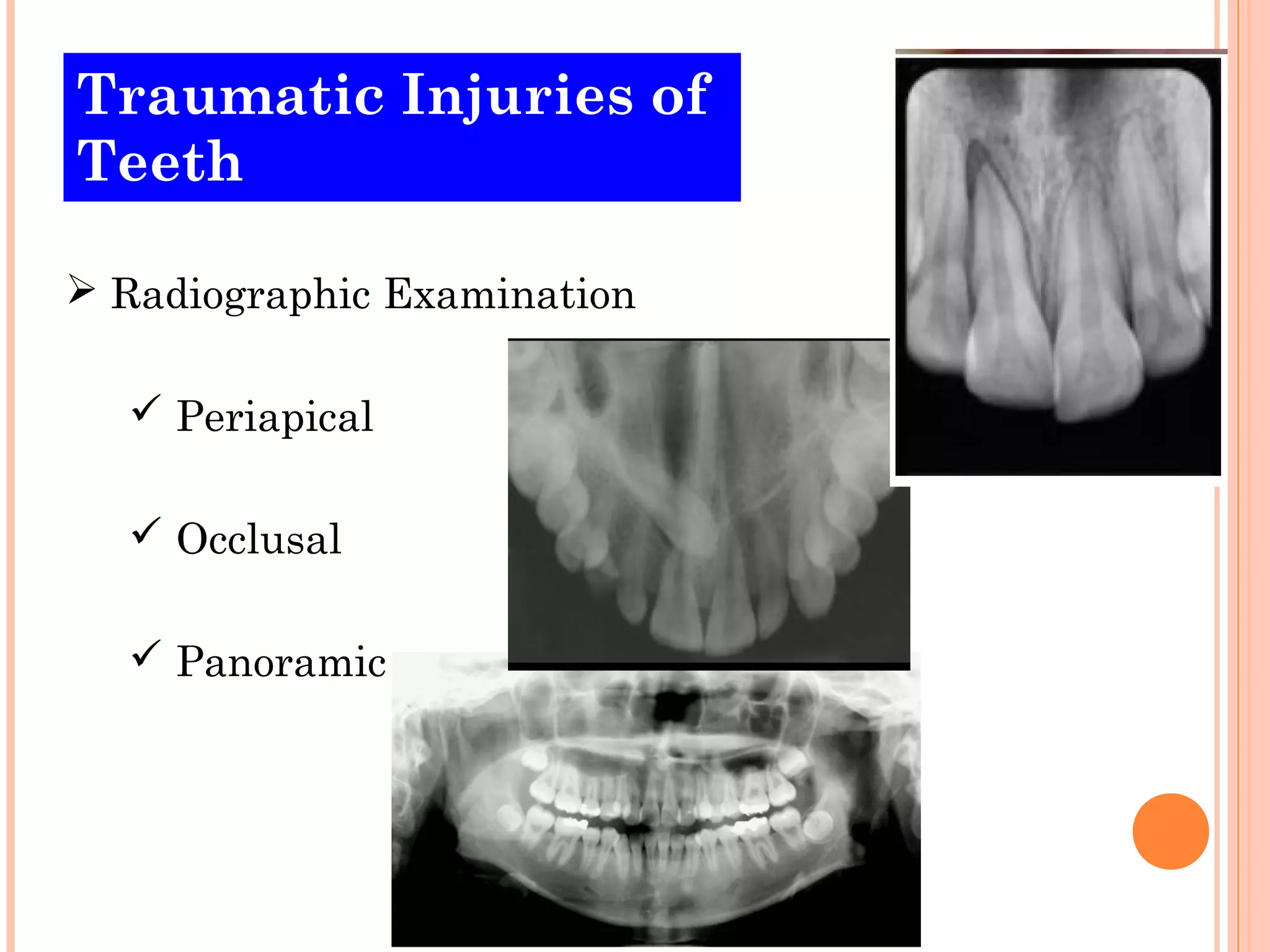Traumatic injuries of teeth | PPT