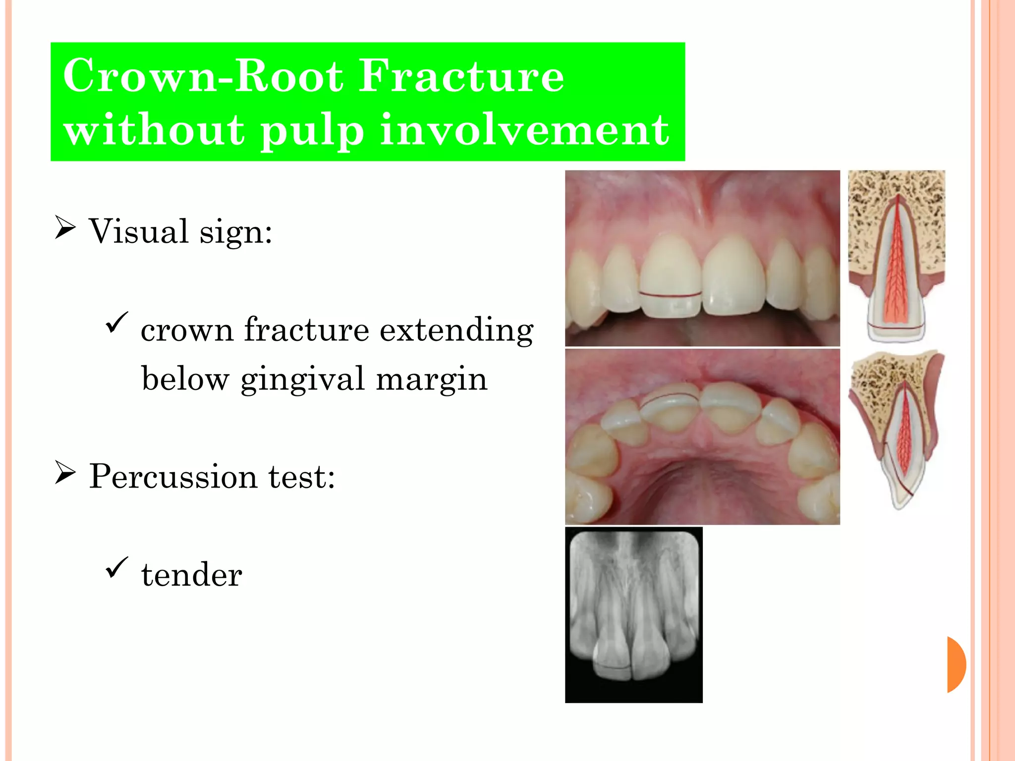 Traumatic injuries of teeth | PPT