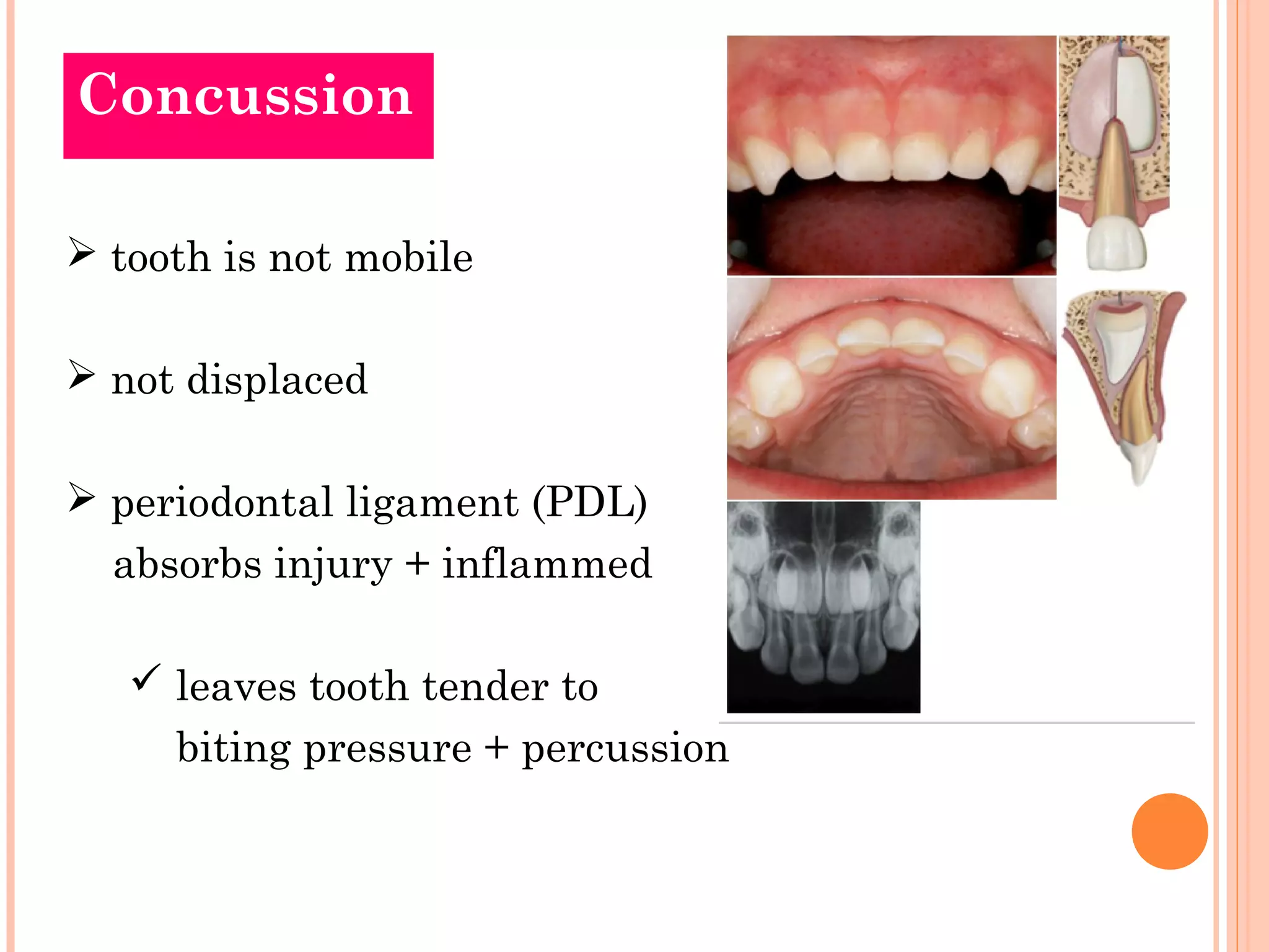 Traumatic injuries of teeth | PPT