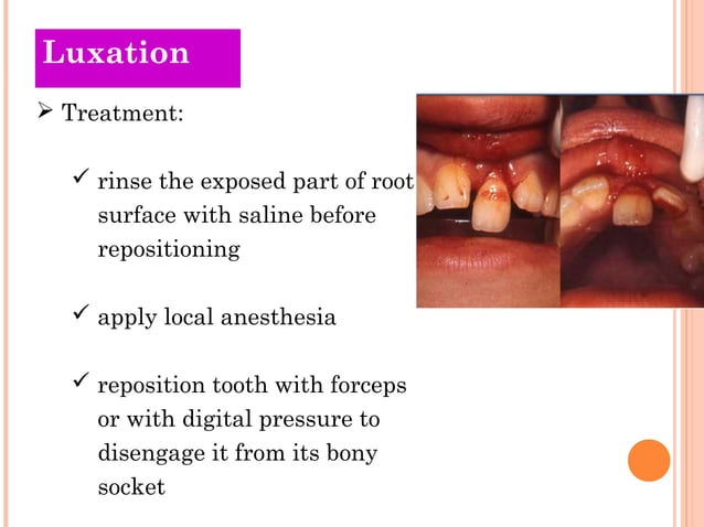Traumatic injuries of teeth | PPT | Dental Health | Diseases and Conditions