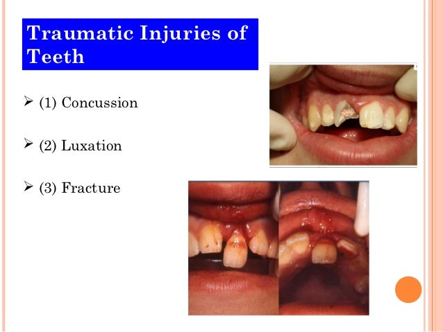 Traumatic injuries of teeth