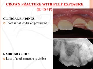 Traumatic injuries of teeth | PPTX