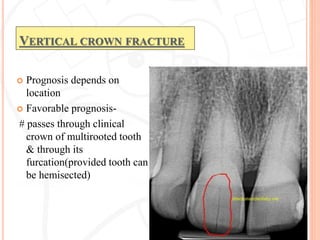 Traumatic injuries of teeth | PPTX