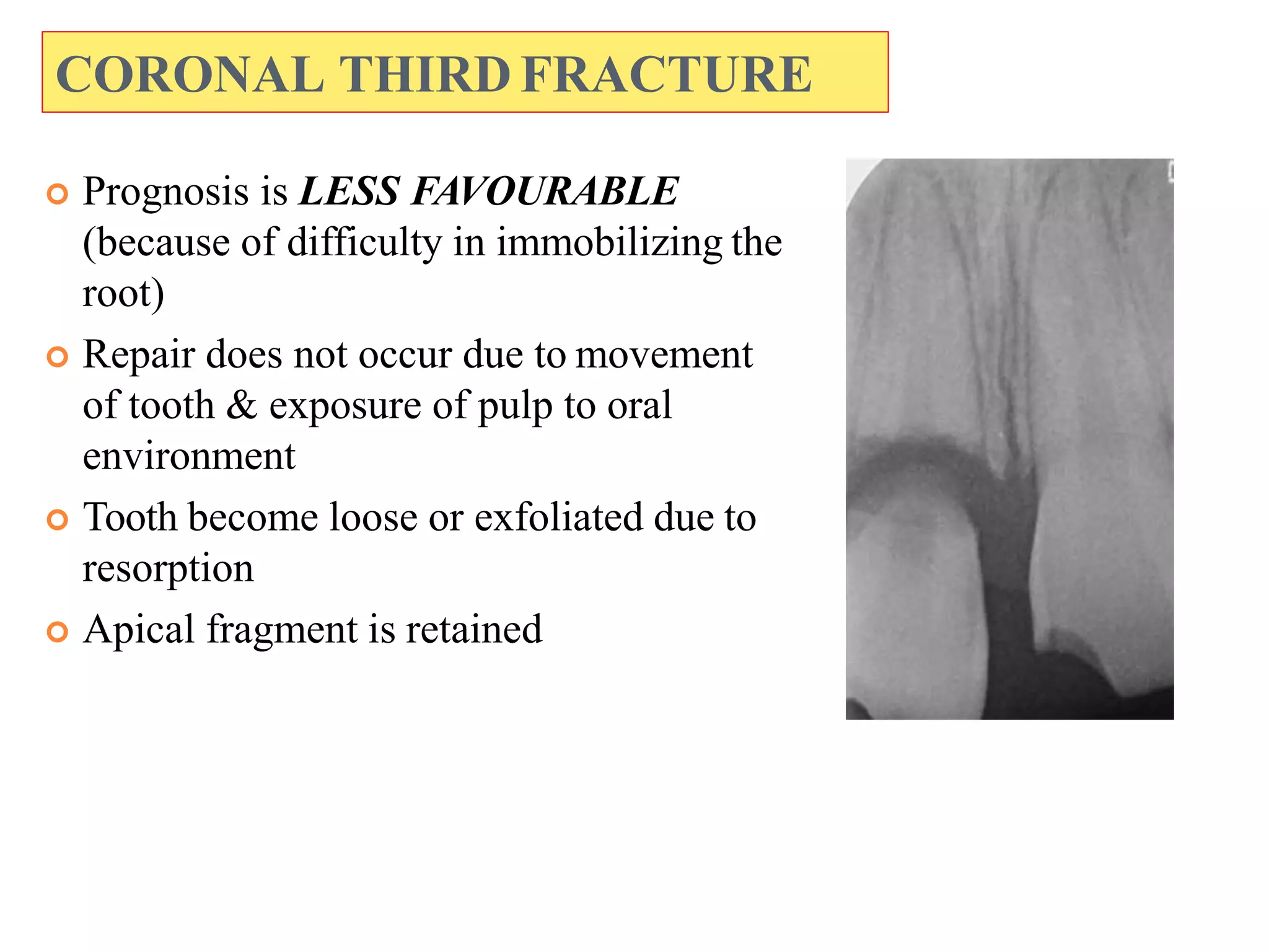 Traumatic injuries of teeth | PPTX