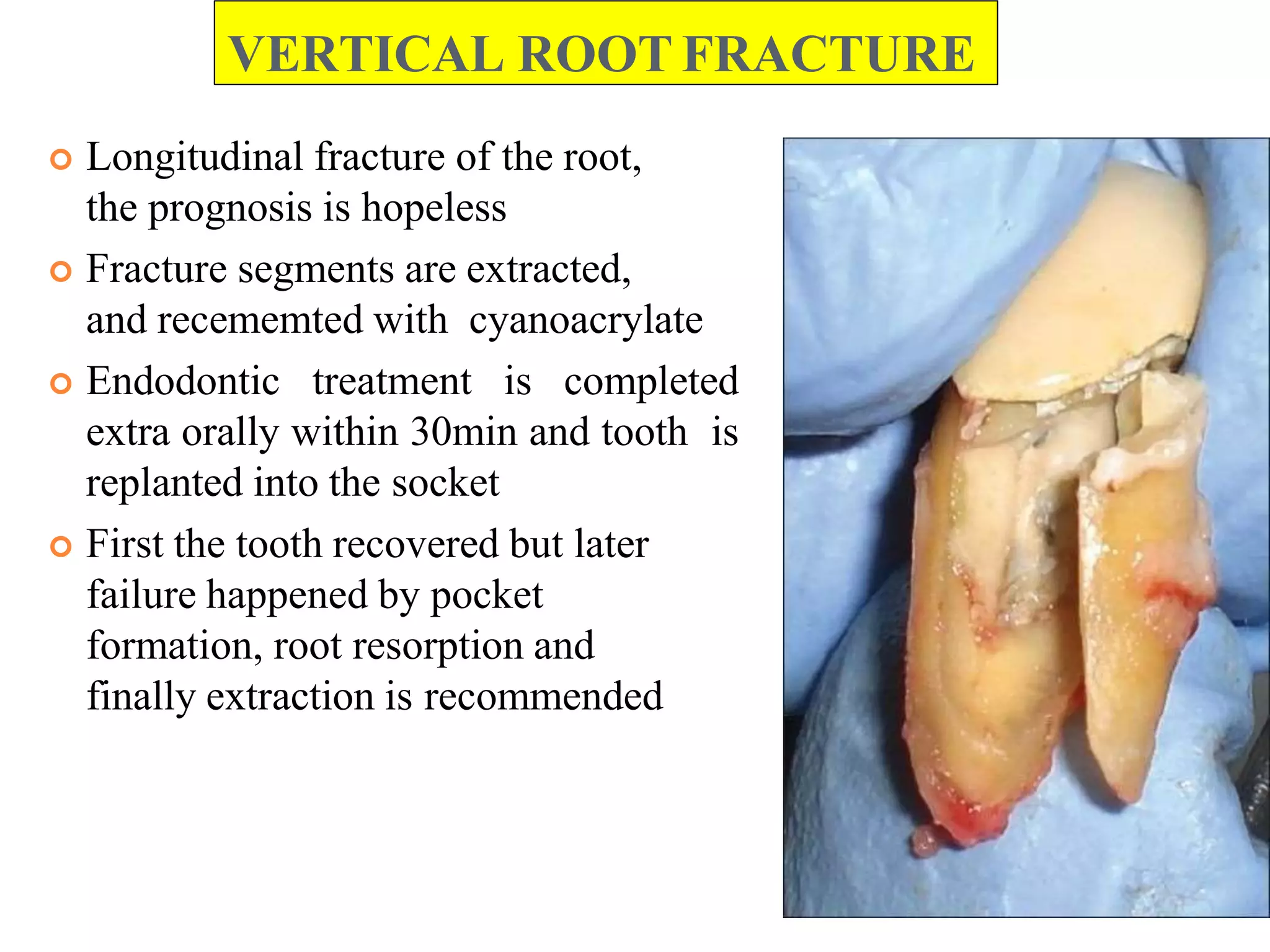 Traumatic injuries of teeth | PPTX