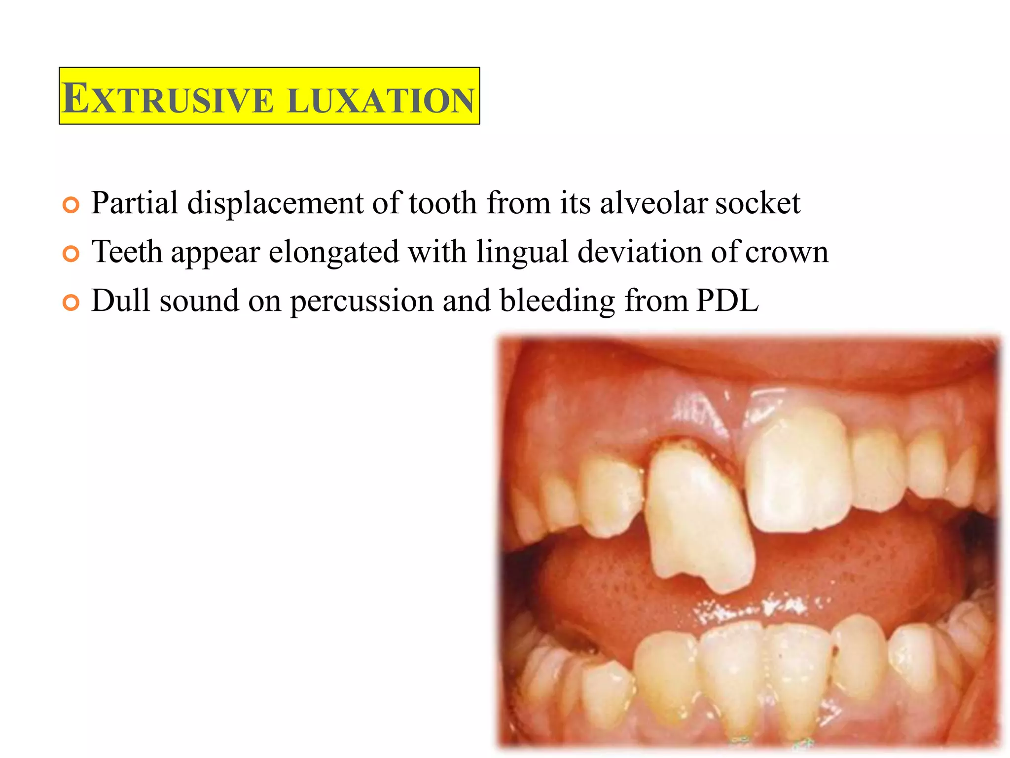 Traumatic injuries of teeth | PPTX