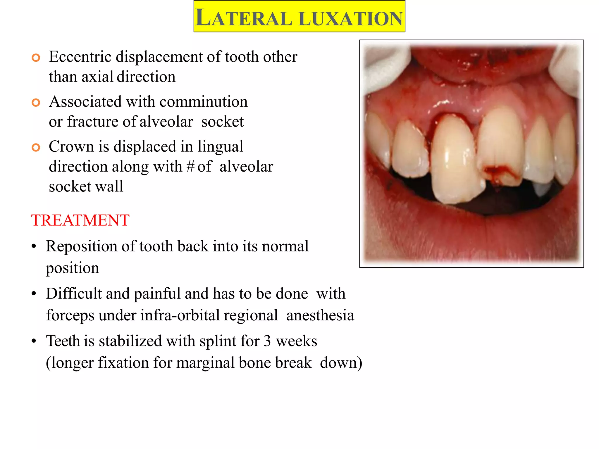 Traumatic injuries of teeth | PPTX