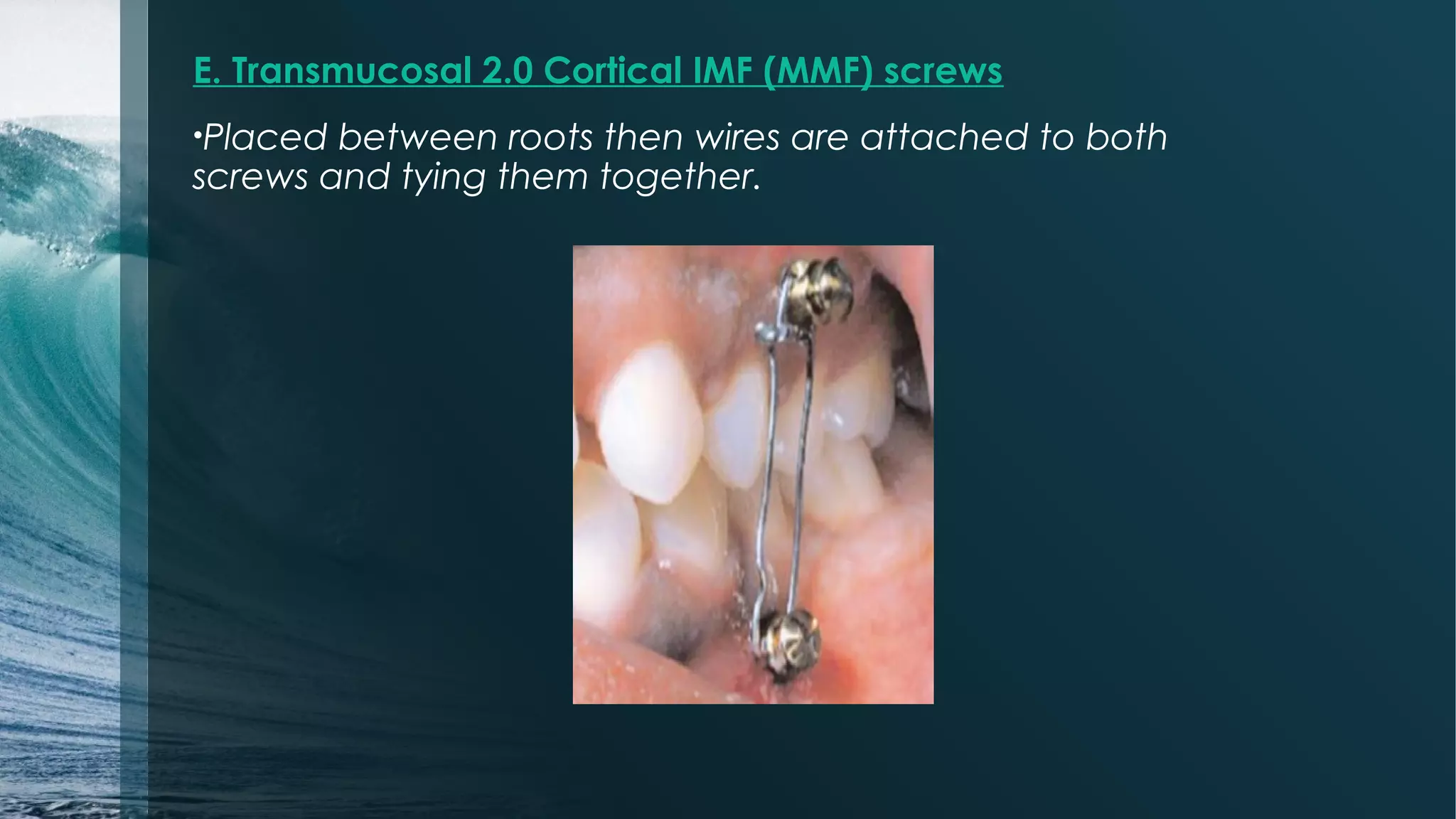 Traumatic injuries of the face and jaws | PPT