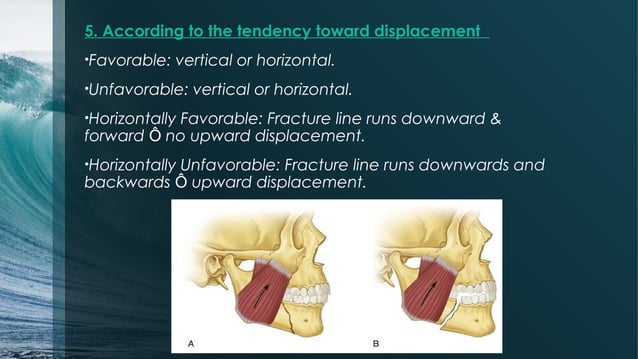 Traumatic injuries of the face and jaws | PPT