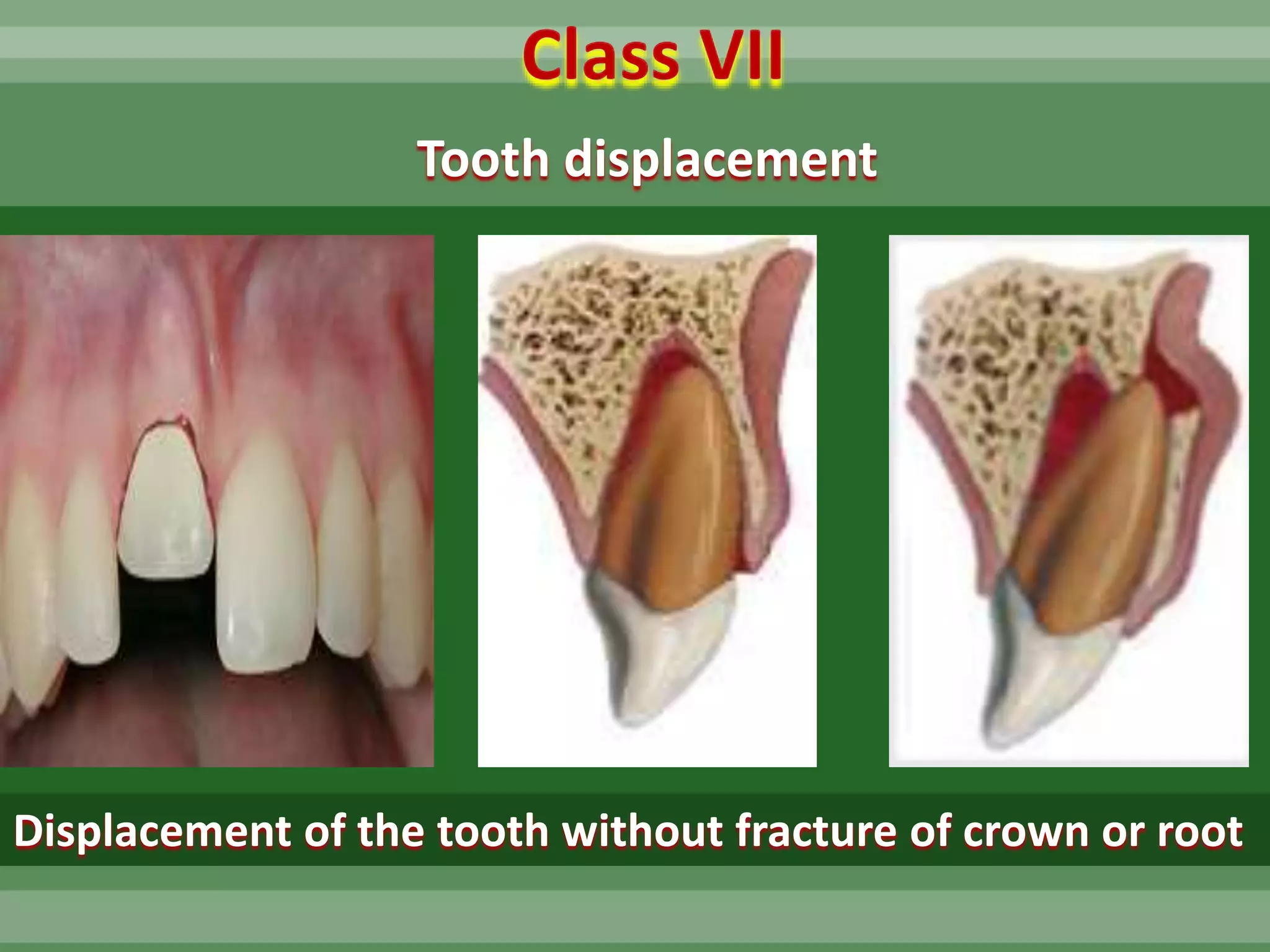 DR SHAKIR Traumatic injuries of teeth in children | PPTX | Dental ...