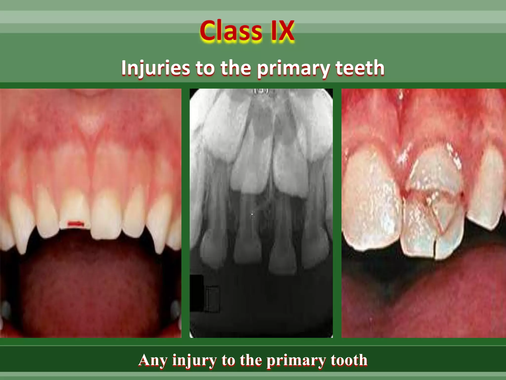 DR SHAKIR Traumatic injuries of teeth in children | PPTX | Dental ...