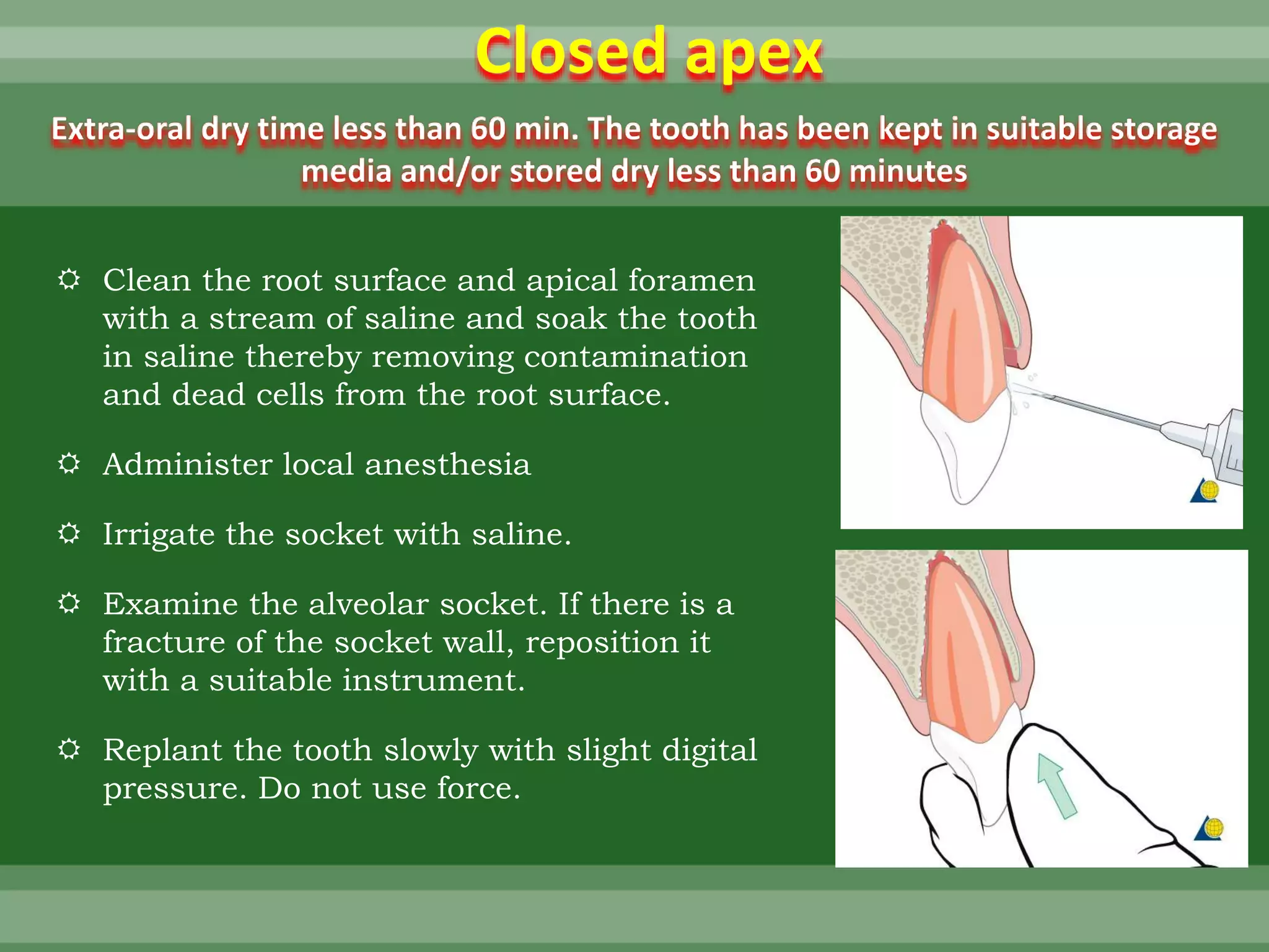 DR SHAKIR Traumatic injuries of teeth in children | PPTX | Dental ...