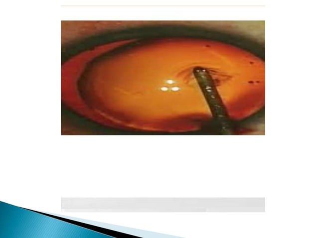 traumatic lens subluxation what to know | PPT