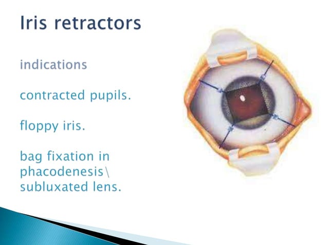 traumatic lens subluxation what to know | PPT