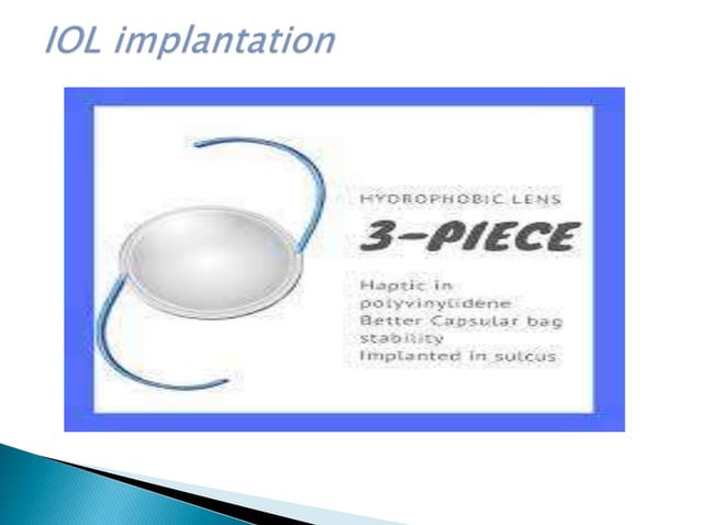 traumatic lens subluxation what to know | PPT