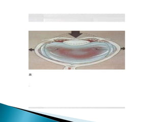 traumatic lens subluxation what to know | PPT