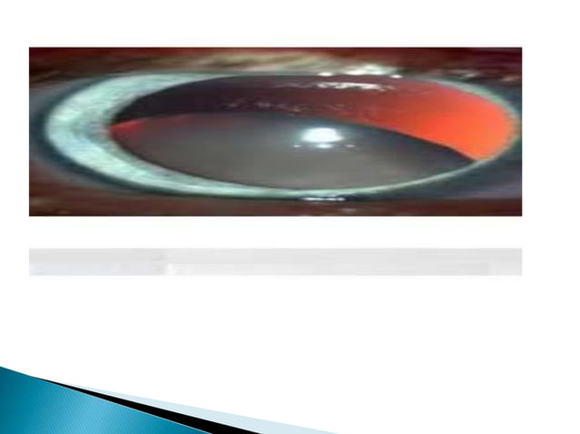 traumatic lens subluxation what to know | PPT