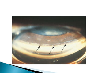 traumatic lens subluxation what to know | PPT