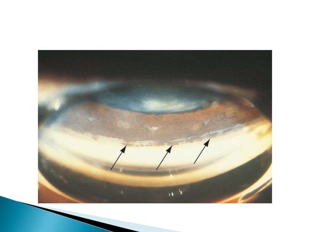 traumatic lens subluxation what to know | PPT