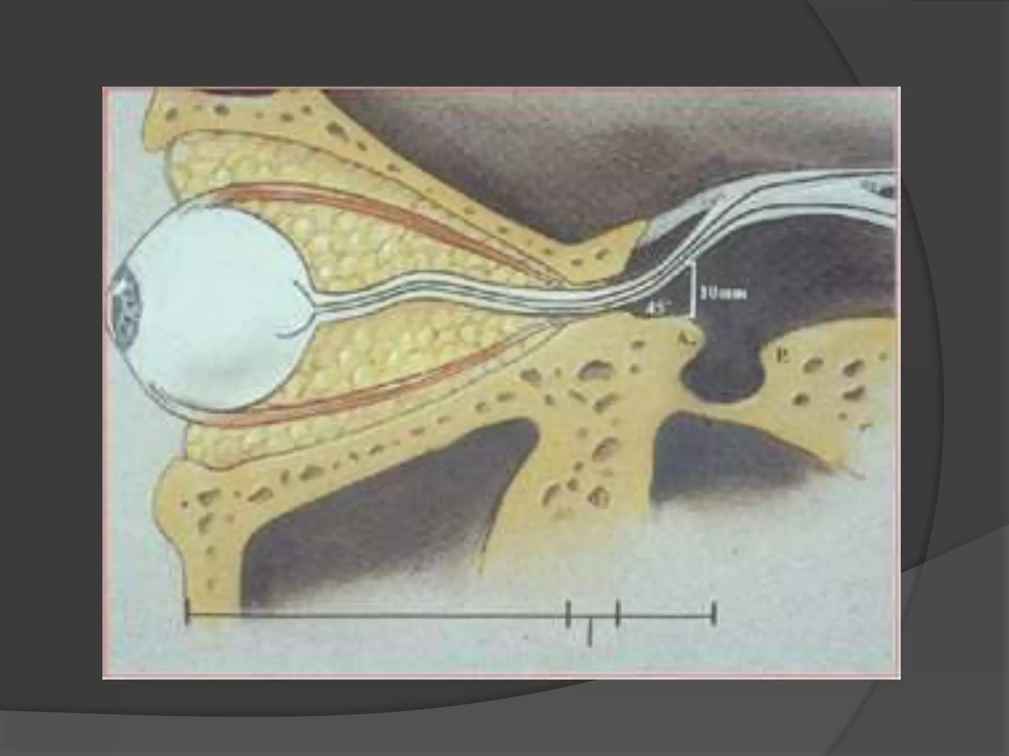 Traumatic optic neuropathy | PPTX