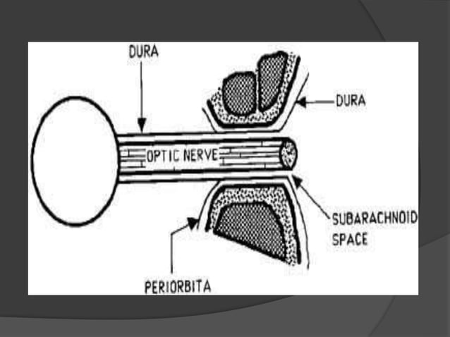 Traumatic optic neuropathy | PPTX