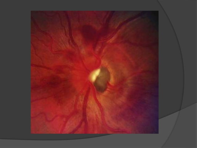 Traumatic optic neuropathy | PPTX