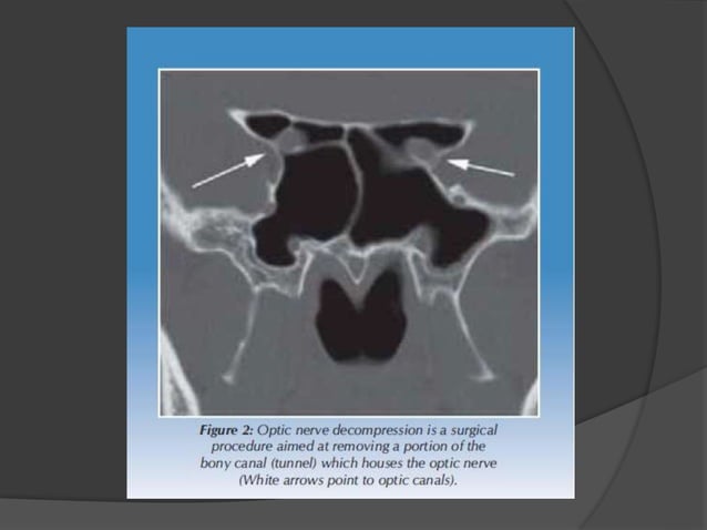 Traumatic optic neuropathy | PPTX