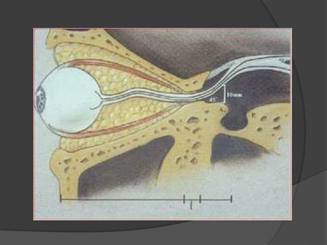 Traumatic optic neuropathy | PPTX