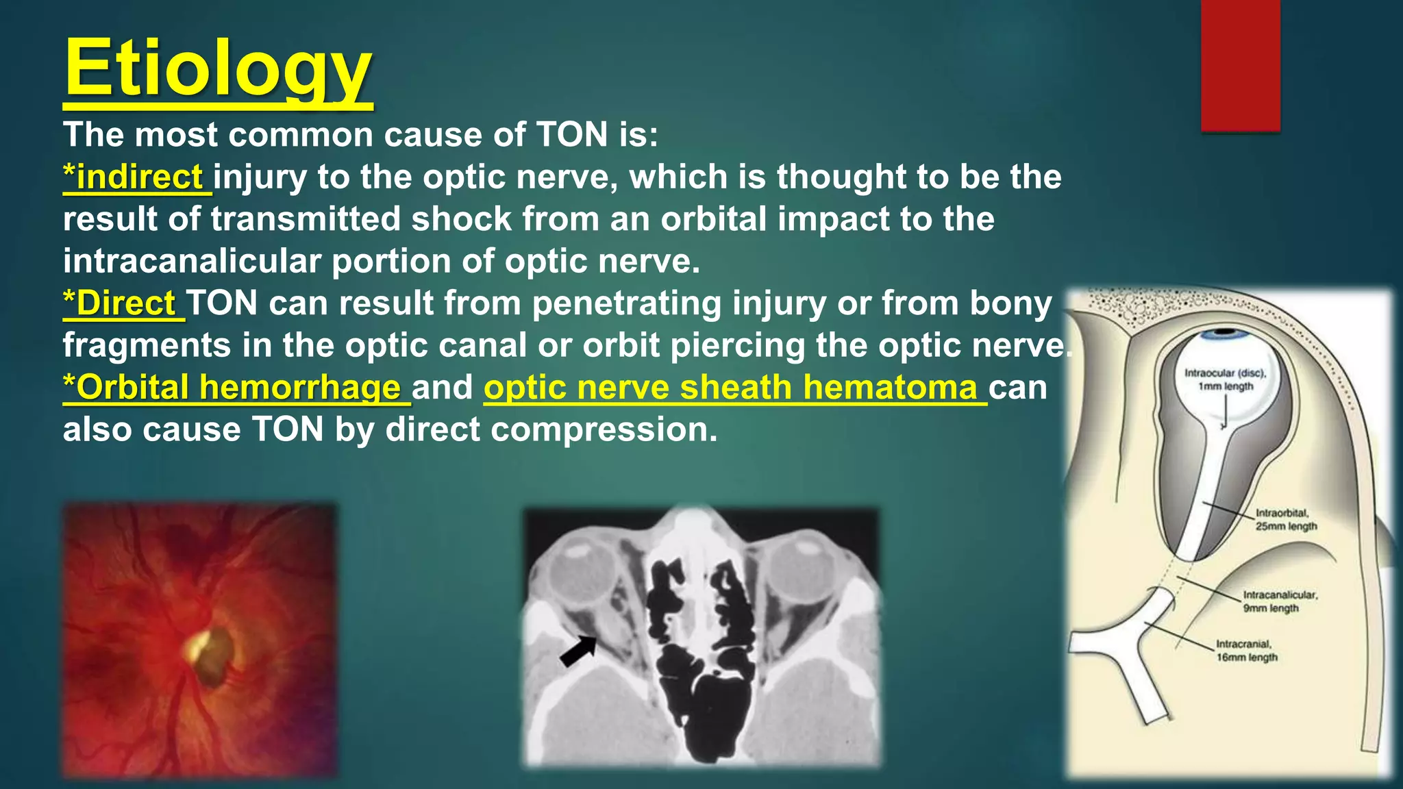Traumatic optic neuropathy | PPTX