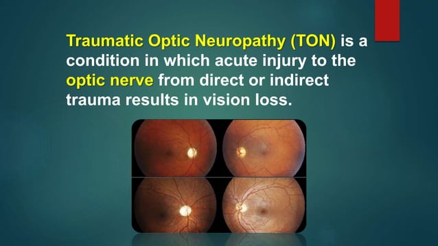 Traumatic optic neuropathy | PPTX