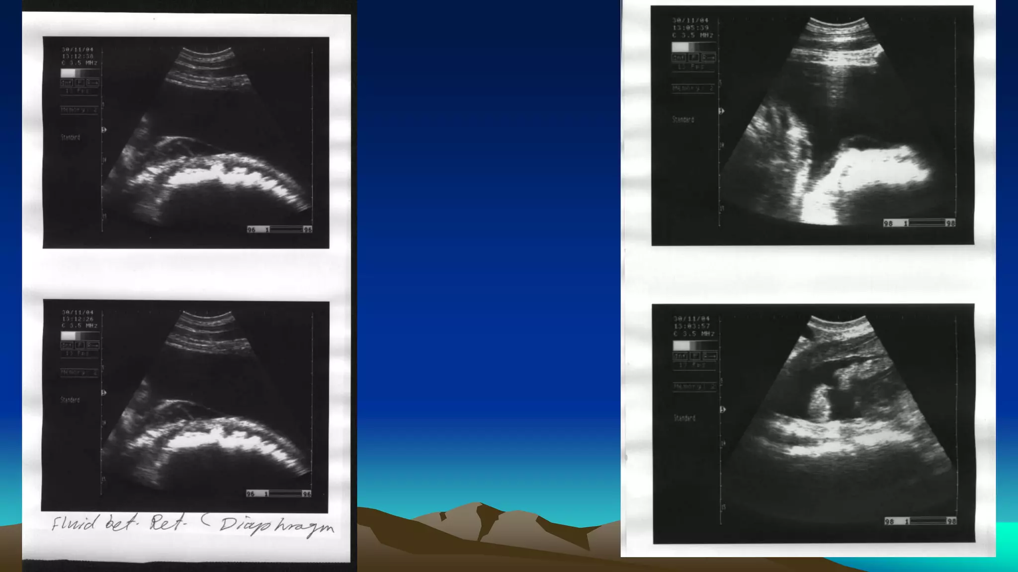 Traumatic reticulo peritonitis | PDF