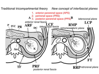Traumatic Retroperitoneal Hematoma | PPTX