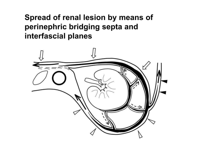 Retroperitoneal Perirenal Retroperitoneum Fascia Hemorrhage Gerota ...
