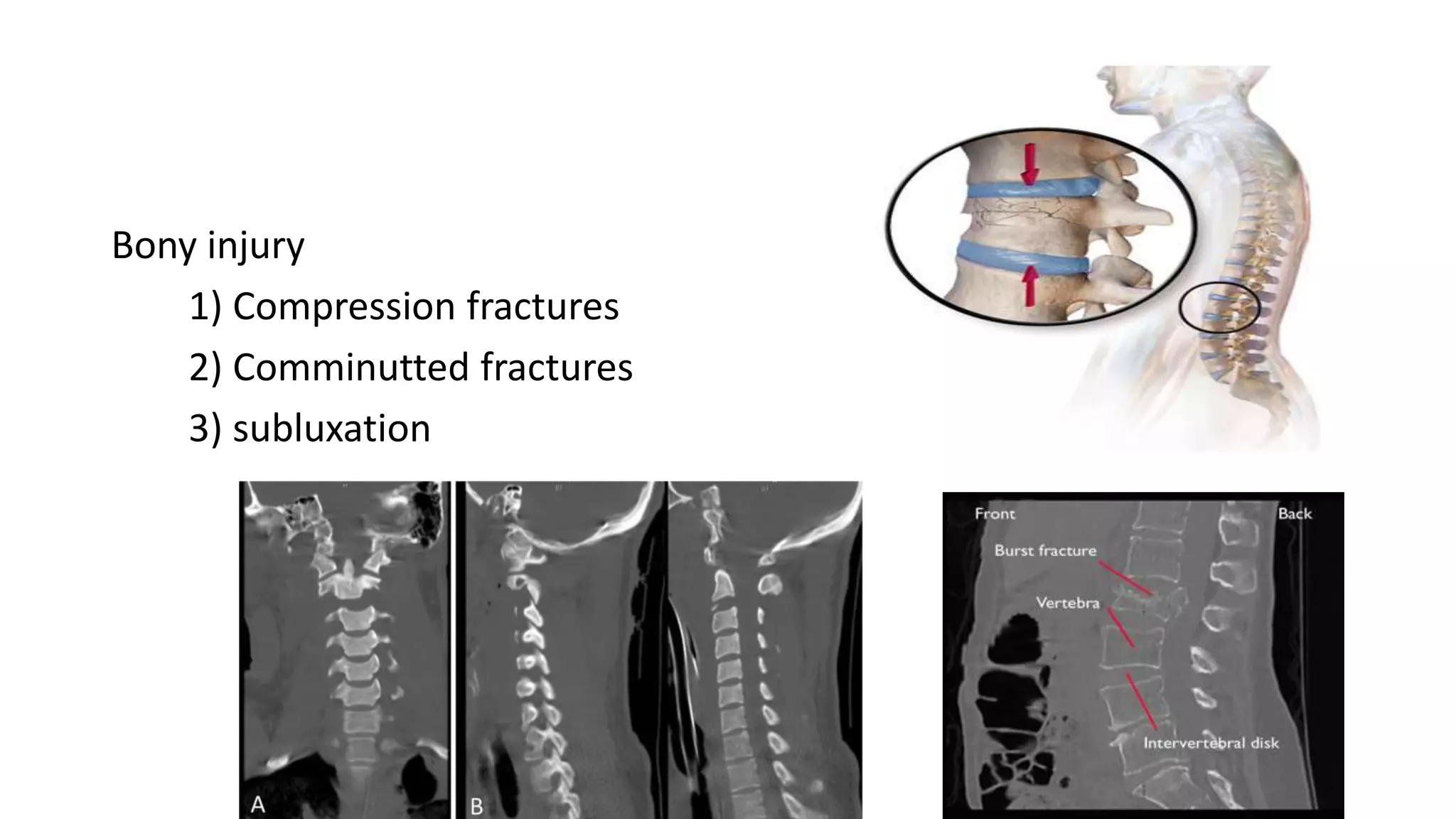 Traumatic spinal injury | PPTX