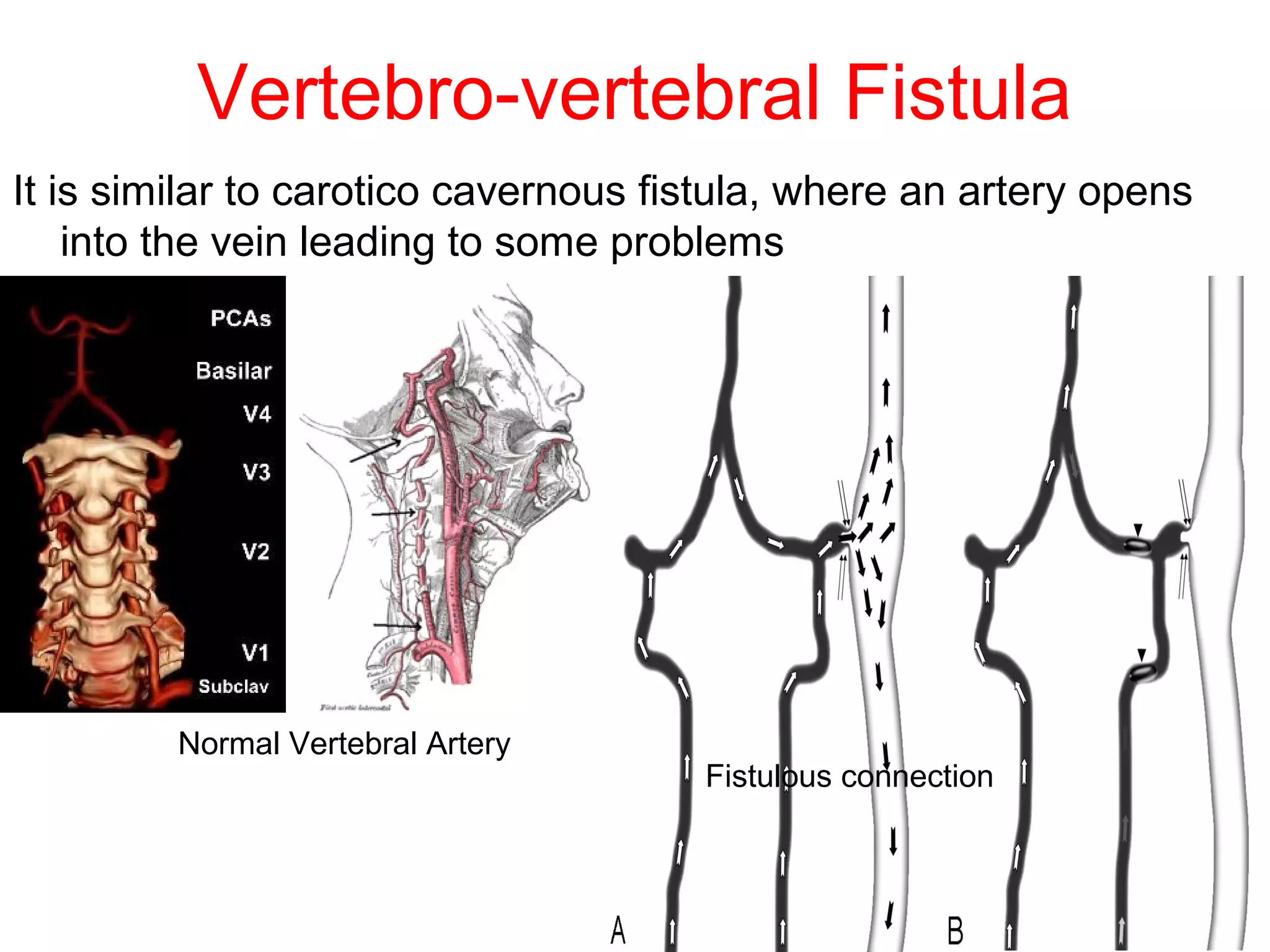 Traumatic vascular injuries of brain | PPT