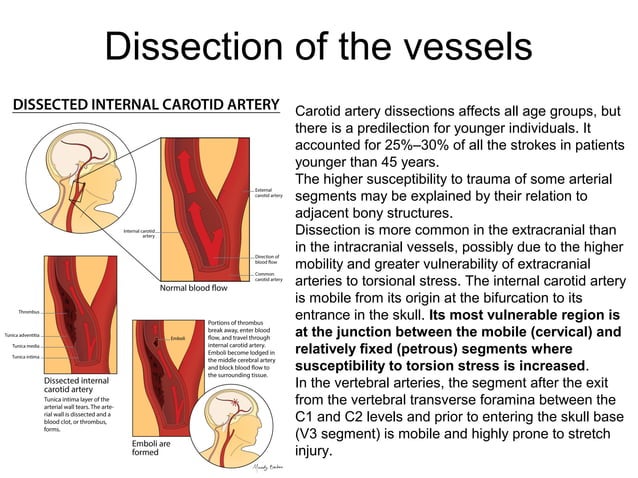 Traumatic vascular injuries of brain | PPT