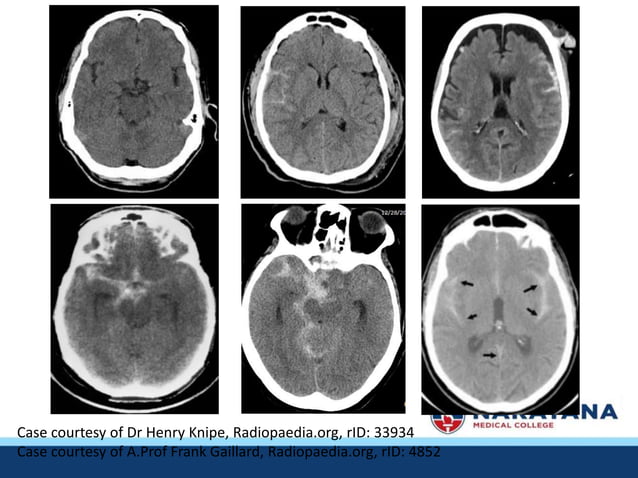 Traumatic Vs Spontaneous Subarachnoid Hemorrhage (SAH) | PPTX