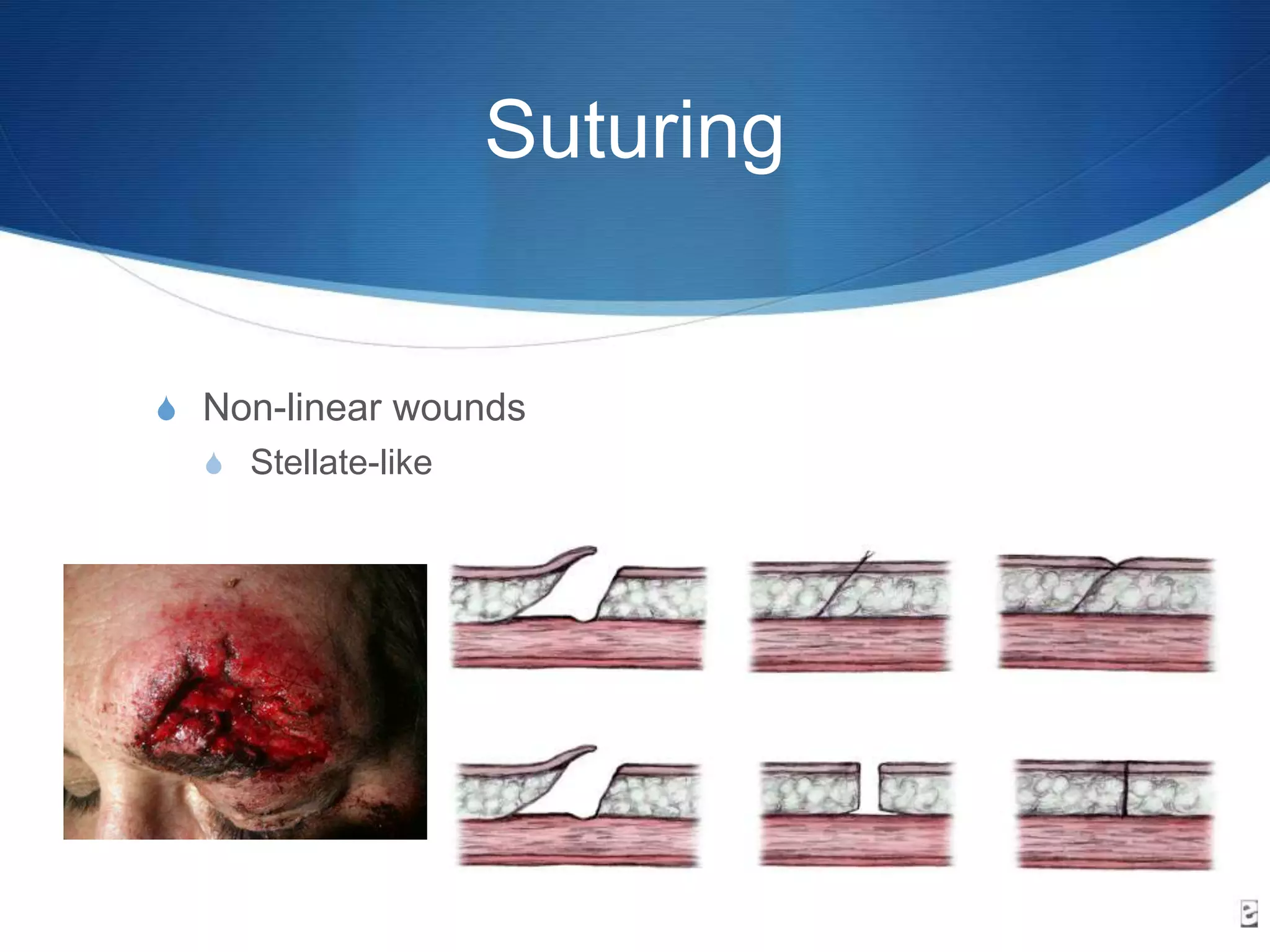 Traumatic wounds in MaxFac | PPTX