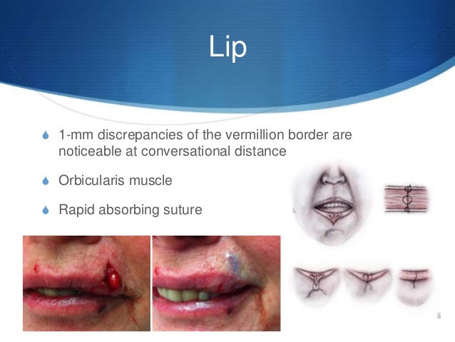 Traumatic wounds in MaxFac