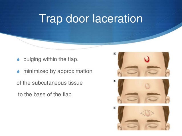 Traumatic wounds in MaxFac