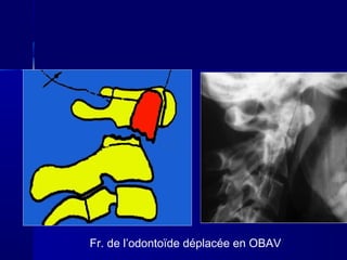 Radiographie De Fracture Odontoïde