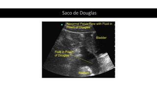 Traumatismo abdominal cerrado | PPTX