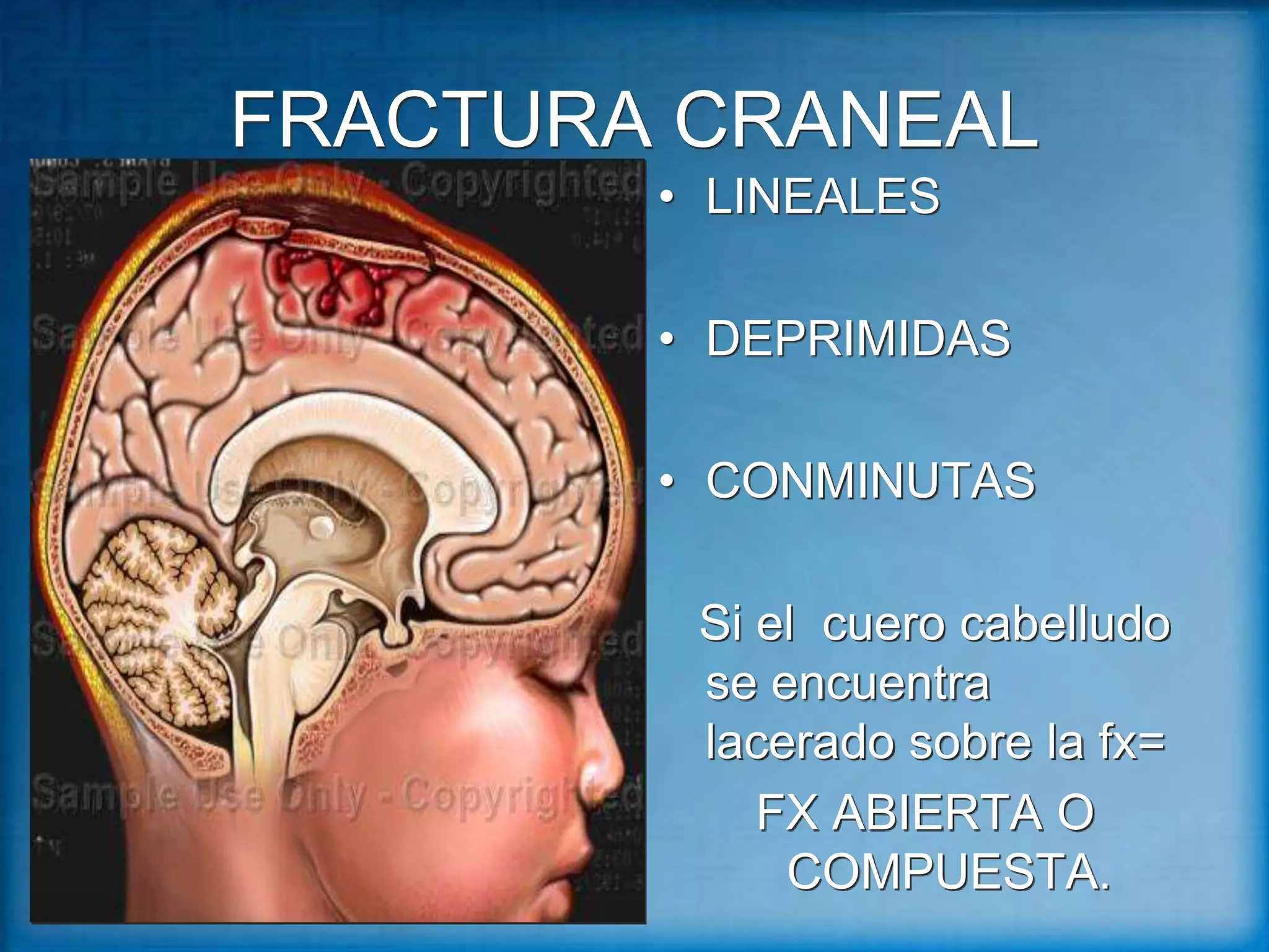 Traumatismo Craneoencefalico Clase