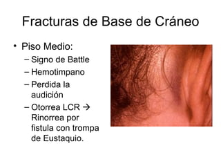 CPHAP 021 Traumatismo Craneoencefalico en pediatria | PPT