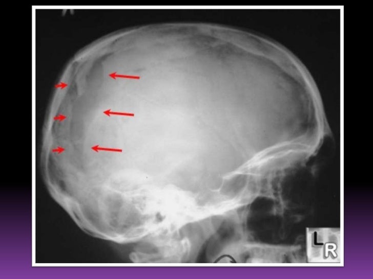Traumatismo craneoencefálico (tce)