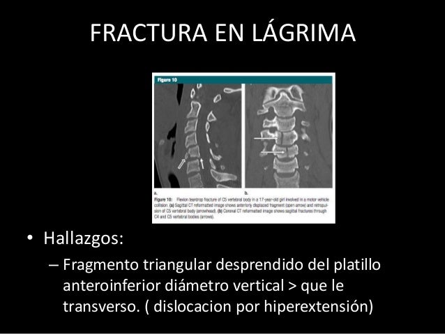 Traumatismo De Columna Cervical Traumatismo De Columna Cervical