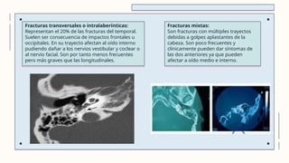 TRAUMATISMO DEL OÍDO. Otorringologia .pptx