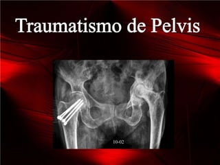 Traumatismo De Pelvis | PPTX